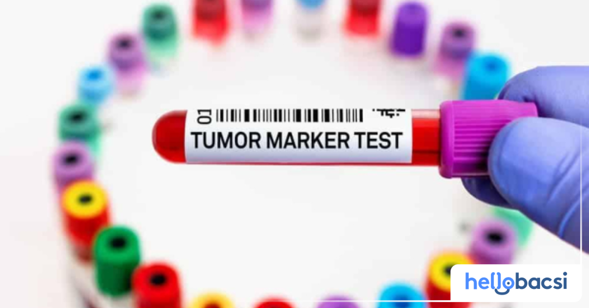Marker ung thư là gì? Marker của các bệnh ung thư thường gặp